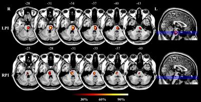 Frontiers | Widespread White Matter Microstructure Alterations Based on Diffusion Tensor Imaging ...